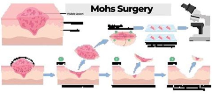 Do you need to rest after Mohs surgery? - TruthTrack News