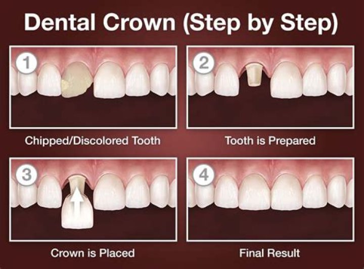 How long does it take to get a permanent crown put on? - TruthTrack News