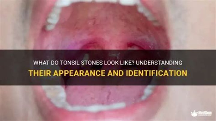 What does a tonsil stone look like? - TruthTrack News